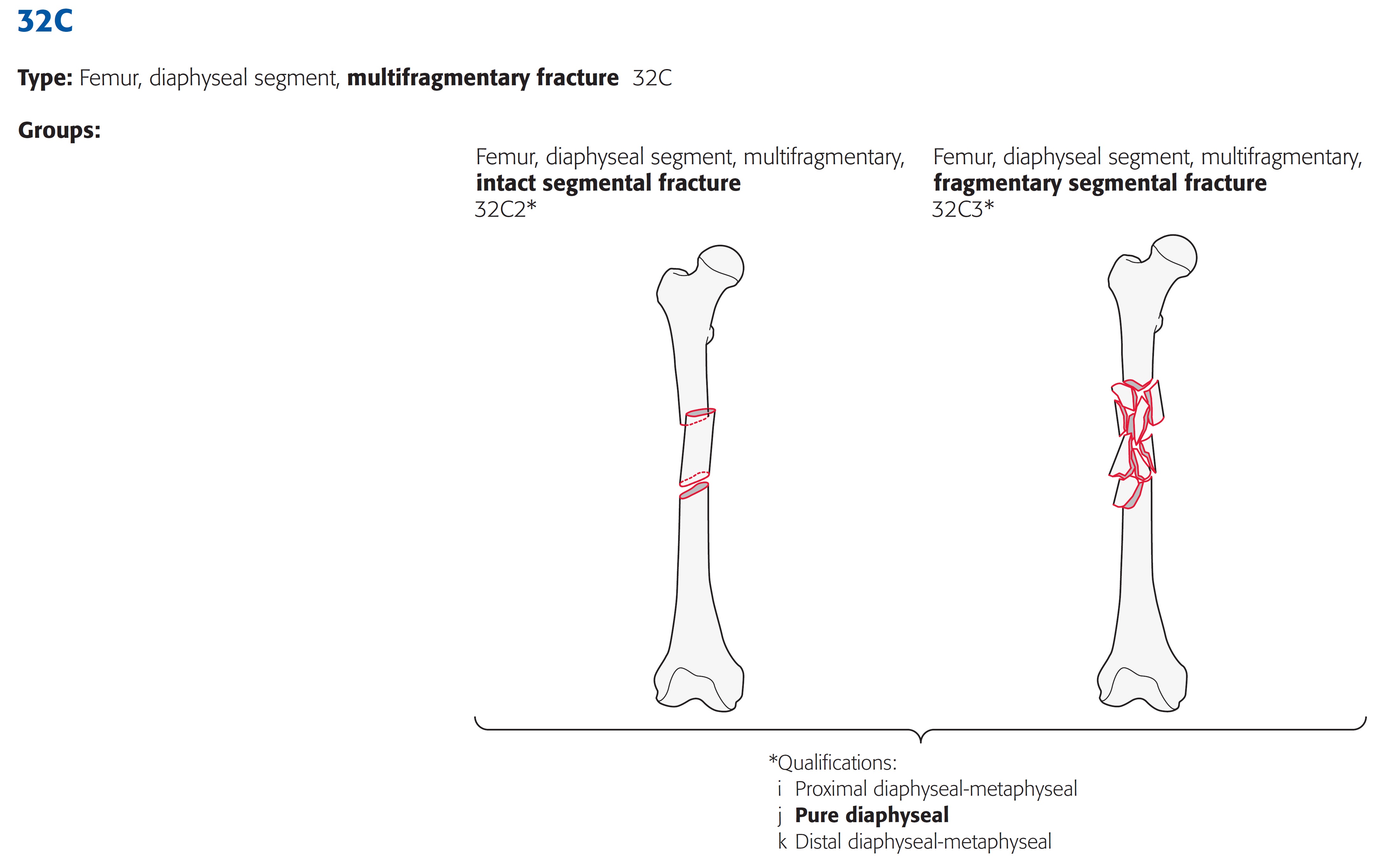 Femur - Putzbrunn Fraktur-Klassifikationen